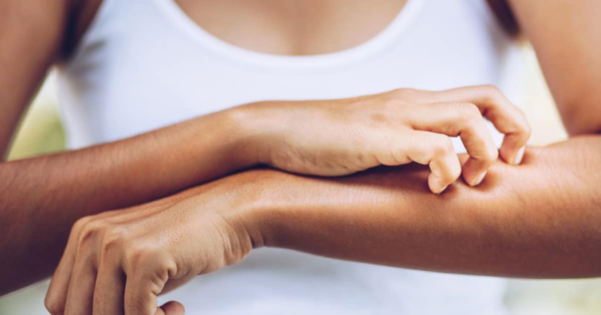 Gebeten door een mug of processie-rups: zó herken je het verschil