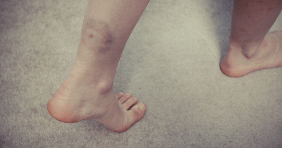 Altijd onder de blauwe plekken: hoe kan dat? - Flair - Voor jou, over ...