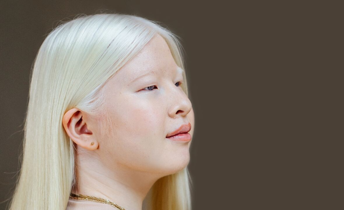 Xueli (18) heeft albinisme: ‘Dat mensen mij nastaren, snap ik wel’ | Flair