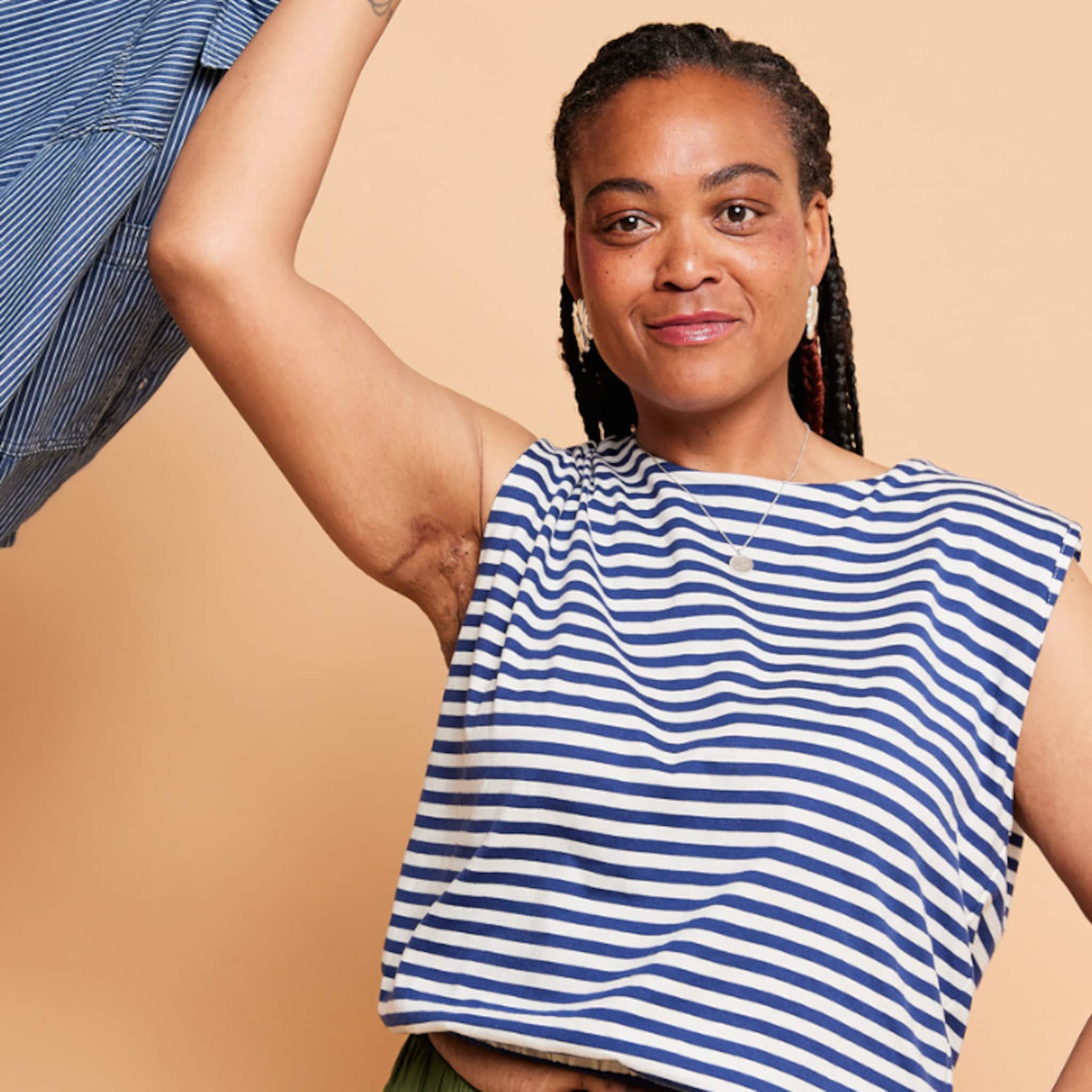 Astrid (34) heeft een vulva-aandoening